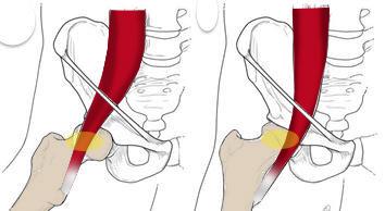 Coxa saltans (cadera en resorte) – Dr. José Hormazábal Traumatólogo