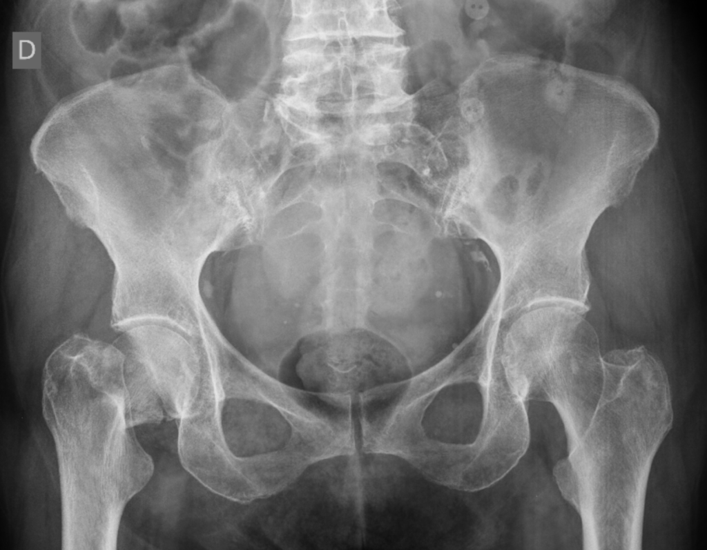 Fracturas de cadera – drhormabazal